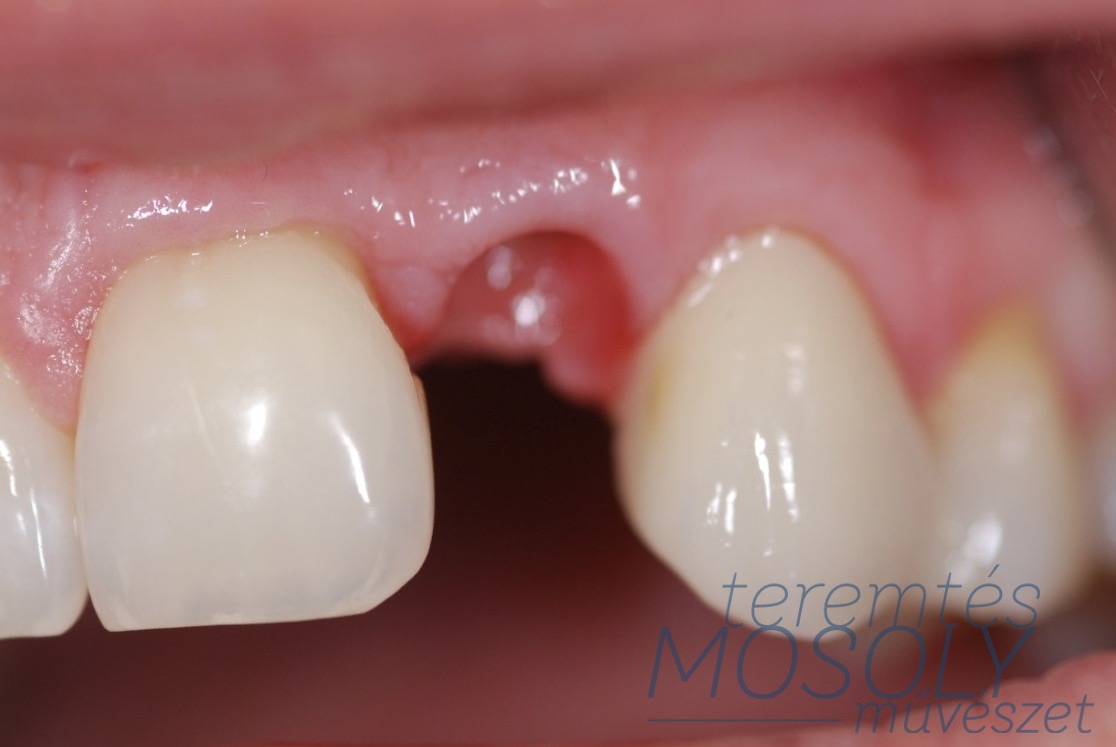Consequences of tooth loss